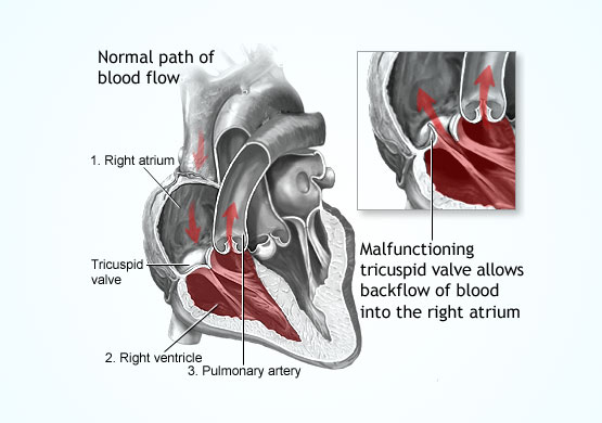 TRICVALVE (Transcatheter Bicaval Valve) - Relisys Medical Devices