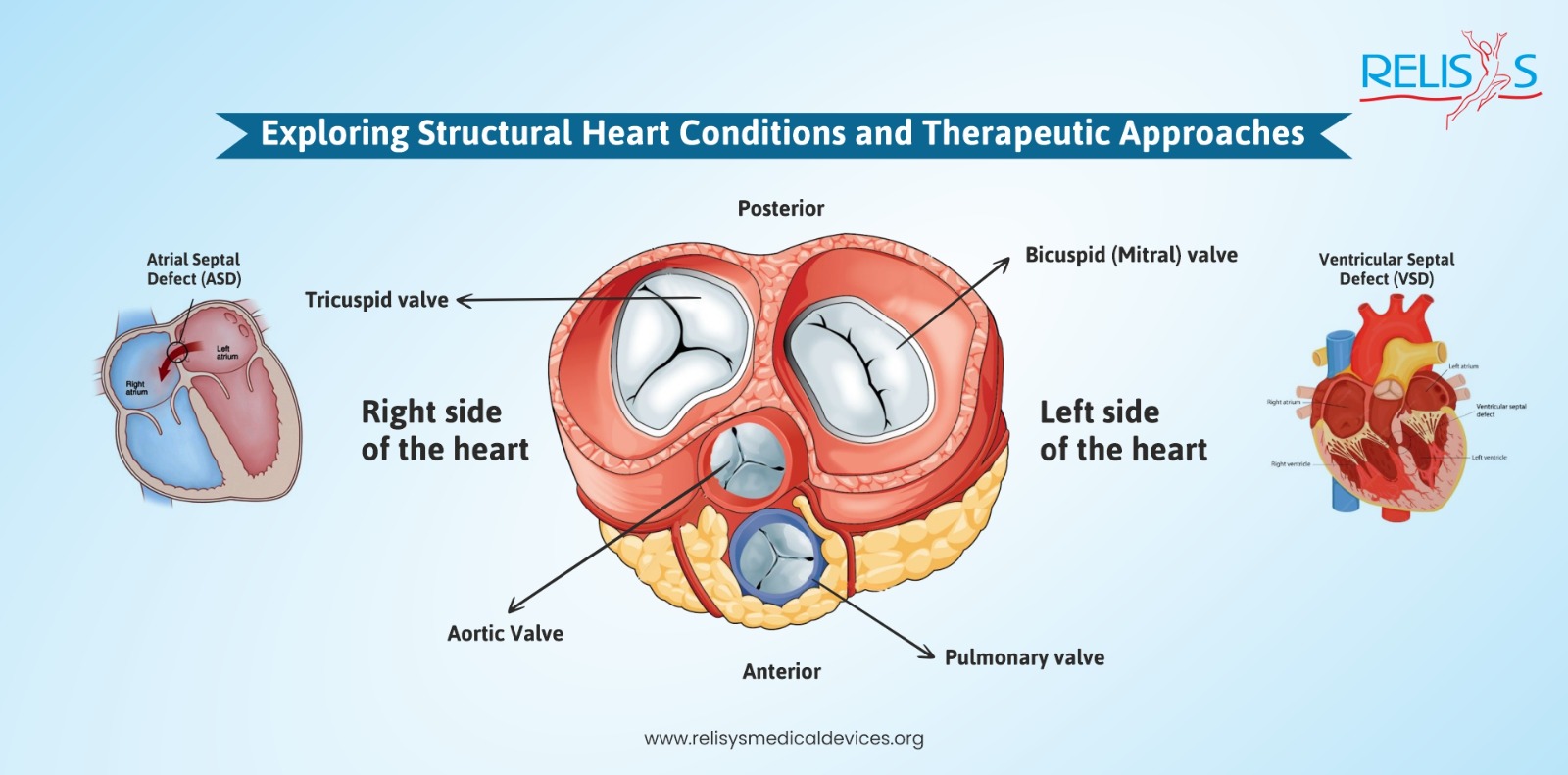 Exploring Structural Heart Conditions and Therapeutic Approaches ...